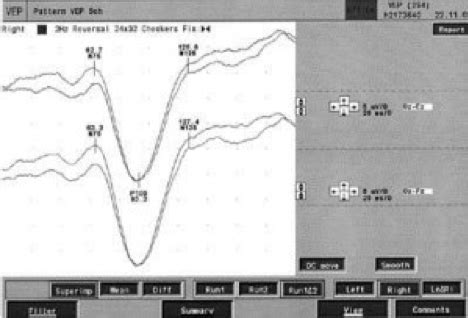 What Is A VEP Association Of Neurophysiology Scientists Of Australia Inc