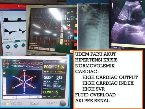 Penanganan Edema Paru Pada PreEklampsia Pdf Pregnancy Reproductive Health