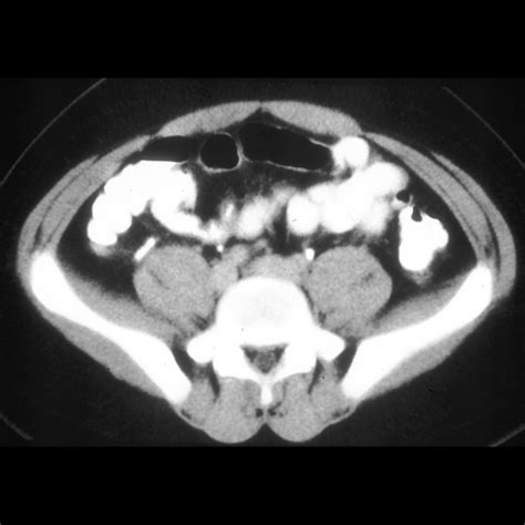Pediatric Appendicitis Pediatric Radiology Reference Article