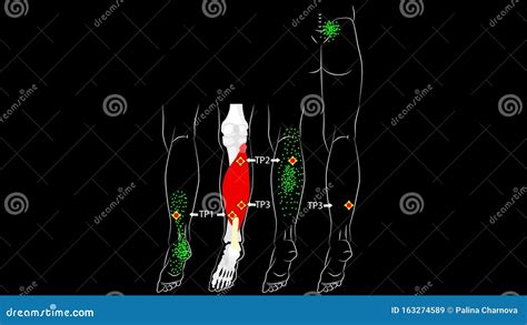 The Structure Of The Trigger Point In The Muscle Attachment Trigger Point Taut Band