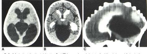 Figure 2 From Arachnoid Cyst Of The Quadrigeminal Plate Semantic Scholar
