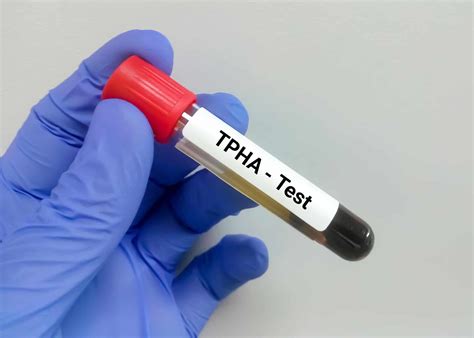 What Is Fta Abs Blood Test At Andrea Cahill Blog