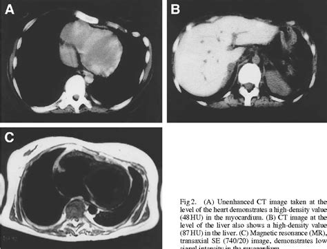 Figure 2 From Cardiac Dysfunction Because Of Secondary Hemochromatosis