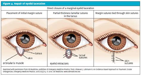 Cpt Code For Laceration Repair Of Eyebrow Eyebrowshaper