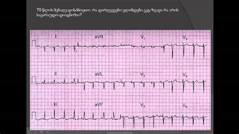 ეკგ ფქოდი გულის მობრუნება საათის ისრის მიმართულებით გულის ელექტრული ღერძის მარჯვნივ
