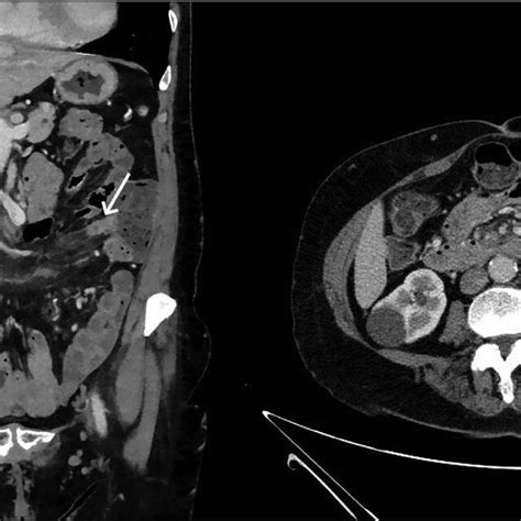 Coronal And Axial Ct Images Demonstrating Appendix Located Adjacent To