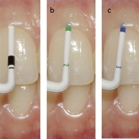 Assessment Of Gingival Phenotype Using A White B Green And C Blue