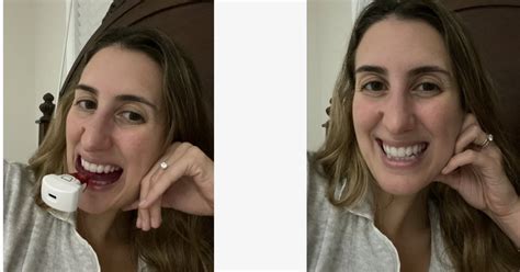 Byte Invisible Aligners Cost And Review Popsugar Beauty