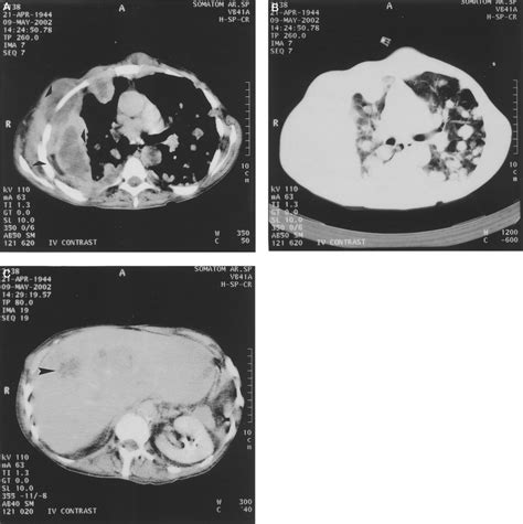 Computed Tomographic Scans Of The Thorax A B Show The Presence Of A