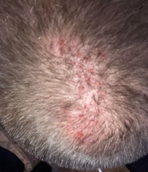 Melanoma With Sunscreen Allergies Rdermatologyquestions