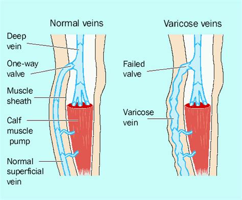 Where Is The Gastrocnemius Vein Located