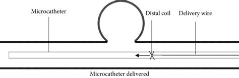 Deployment Procedure Of Flow Diverter Without Compaction Download