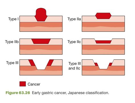 Ahmed Mansy On Linkedin Lauren Borrmann And Japanese Classification Of Gastric Cancer Misirg1