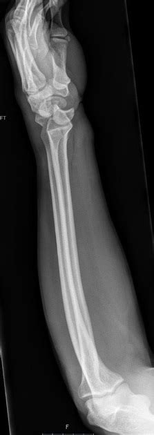 Perilunate Fracture Dislocation Pacs