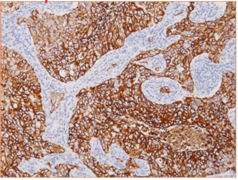Neoplasia 3 Metastasis Flashcards Quizlet