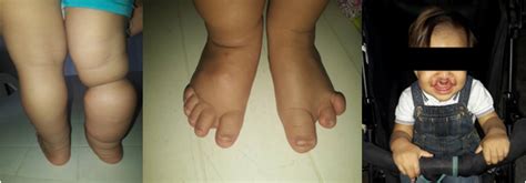 The New Karyotypic Alteration In A Patient With Cleft Lip And Palate Ectrodactyly And Ectodermal