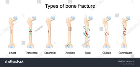 Types Bone Fracture Femur Bone Vector Stock Vector Royalty Free 2469834367 Shutterstock