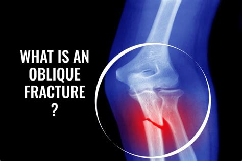 Oblique Fracture Symptoms Causes And Treatment Er Of Mesquite