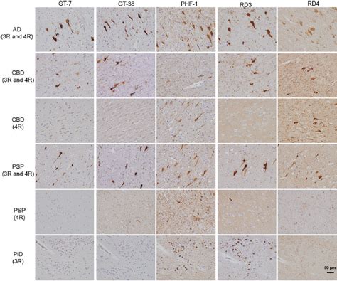 Figure 4 From Detection Of Alzheimer Disease Ad Specific Tau Pathology In Ad And Nonad