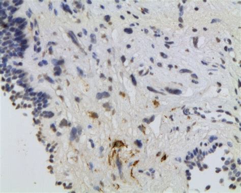 Post Chemotherapy Embryonal Rhabdomyosarcoma Human Pathology