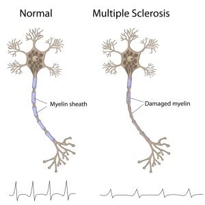 Multiple Sclerosis Health Facts