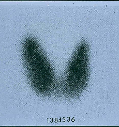 Endocrine Flashcards Quizlet