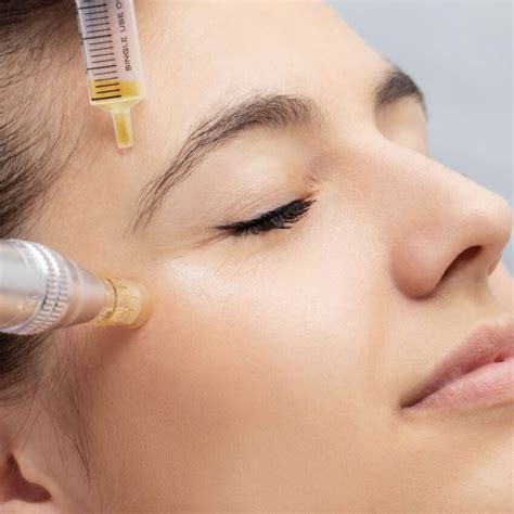 Microneedle Skin Therapy Essential Beauty Medical Spa And Laser Center