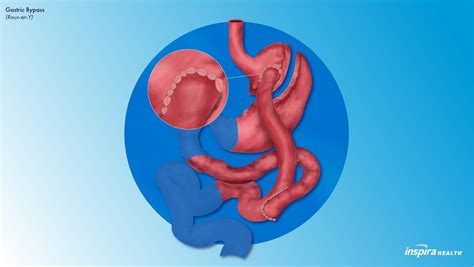 Gastric Bypass Roux En Y Inspira Health