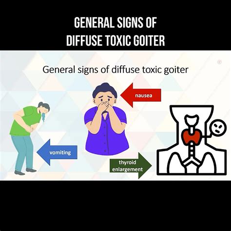 General Signs Of Diffuse Toxic Goiter Endocrinology Basedow Thyroid Thyroiddisorders Youtube