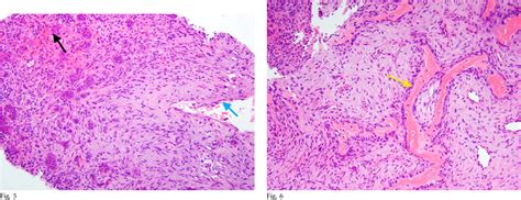 Figure 3 From Aneurysmal Bone Cyst Of The Scaphoid A Case Report Semantic Scholar