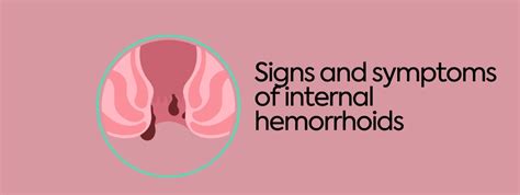 ᐉ How To Recognize And Treat Internal Hemorrhoids