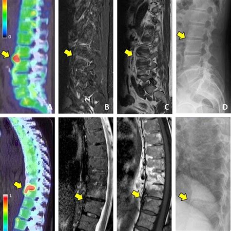 Overview Of Different Types Of Lesions Per Spine Segment For Each Download Scientific Diagram Overview Of Different Types Of Lesions Per Spine Segment For Each Download Scientific Diagram