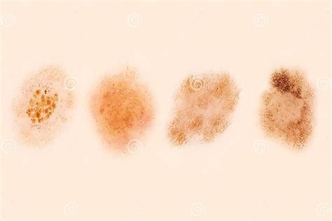 Pattern Of Normal Pigmented Nevi Dermatoscopy Magnified 20 Times Dermatological Set Stock Pattern Of Normal Pigmented Nevi Dermatoscopy Magnified 20 Times Dermatological Set Stock