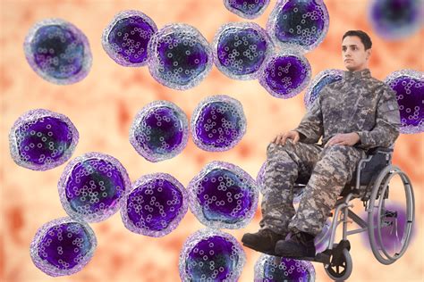 Epstein Barr Virus Linked To Multiple Sclerosis Compelling Evidence Suggests