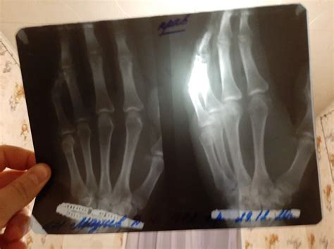 Перелом пястной кости Перелом 3 пястной кости через 2 недели можно гипс Medaboutme