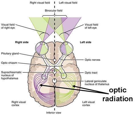 Optic Radiation Distinct Displacements Of The Optic Radiation Based On