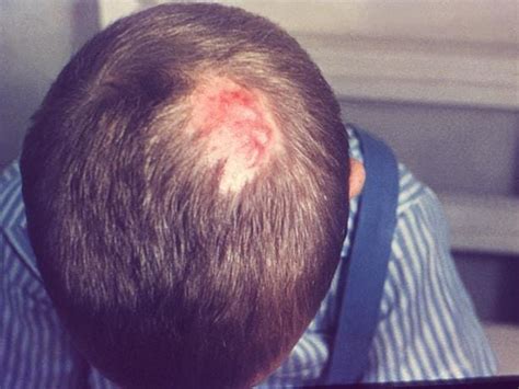 Ringworm In Humans Causes