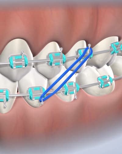 Bite Correction In Tx Full Smile Ortho