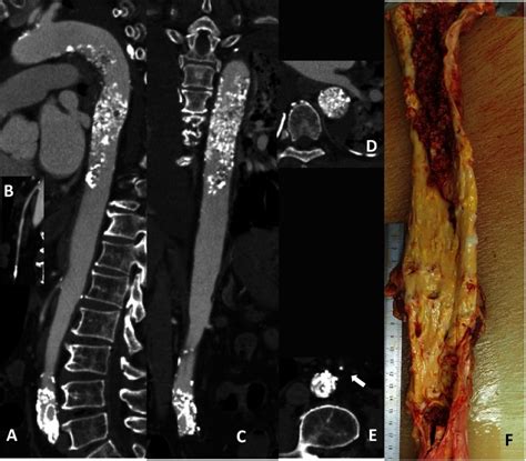 Severe Obstructive Calcification Of The Descending Aorta A Case Report Of “coral Reef Aorta” Pmc