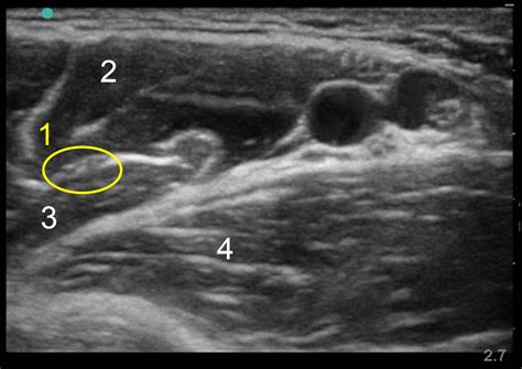 Musculocutaneous Nerve Image Sonosite Institute For Point Of Care Ultrasound