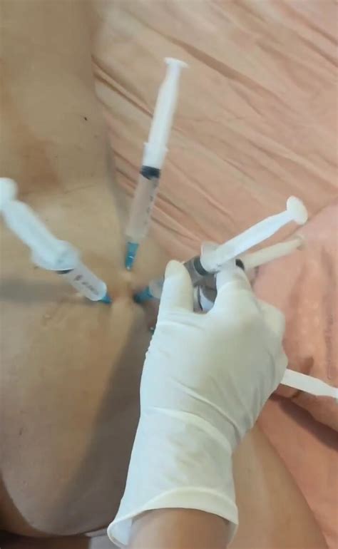 Multiple Injections Video 2