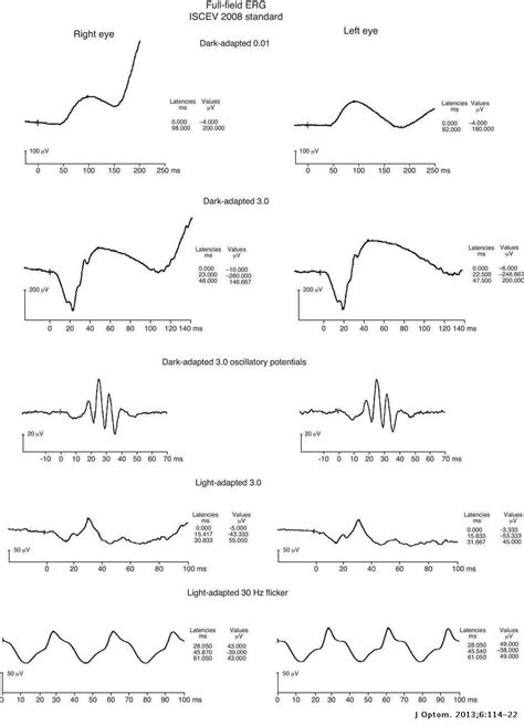 Central Areolar Choroidal Dystrophy With Associated Dominant Drusen