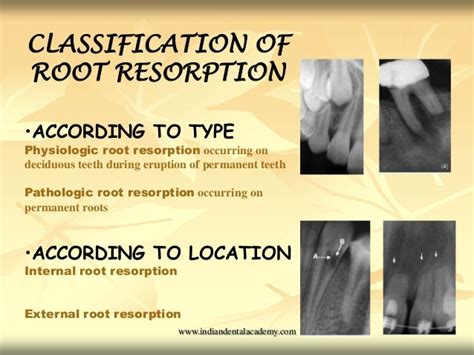 Root Resorption Certified Fixed Orthodontic Courses By Indian Dental