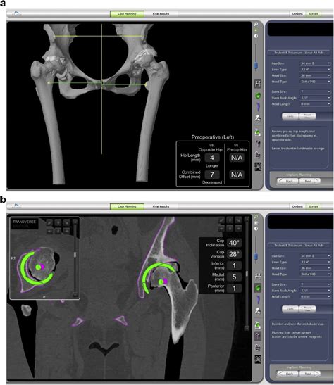 Figure 1 From The Use Of Robotic Assisted Total Hip Arthroplasty In Developmental Dysplasia Of