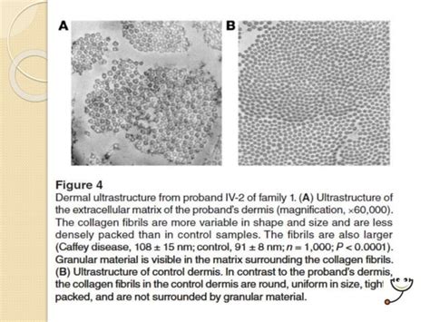 Infantile Cortical Hyperostosis Dr Rohit Kumar Singh Pptx