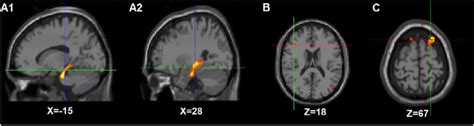 A Whole Brain Gmv Analyses Showing Clusters With Lower Gray Matter Download Scientific Diagram