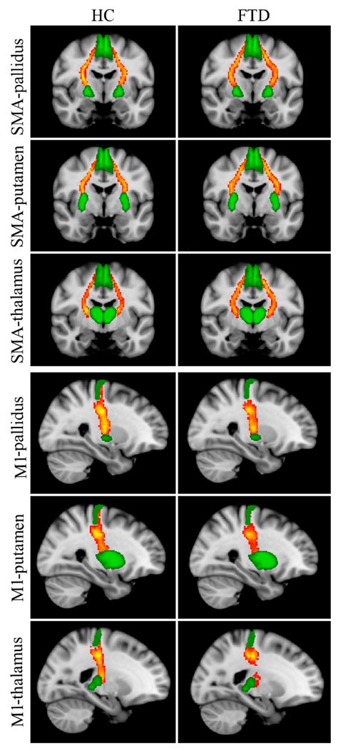 Reconstructed White Matter Pathways In Healthy Controls Hc Left