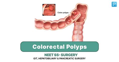 Colorectal Polyps Types Neoplastic Polyps Management And More