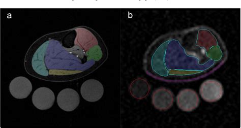 Figure 3 From Sex Differences In Sodium Deposition In Human Muscle And Skin Semantic Scholar