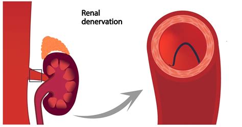 Cms Recommends Coverage For Renal Denervation For Hypertension